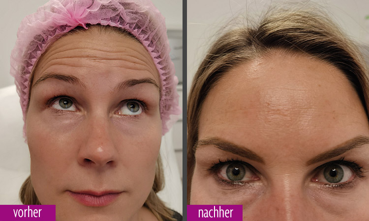 Soft-Botox | Verena Kluth Baden-Baden